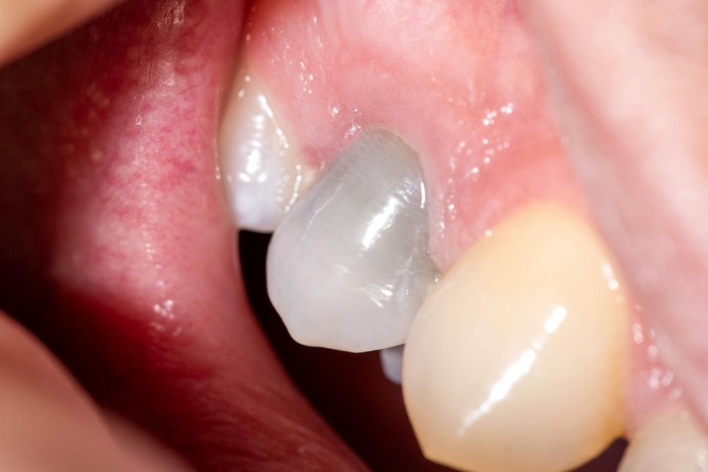 What Does a Dead Tooth Look Like? See Pictures