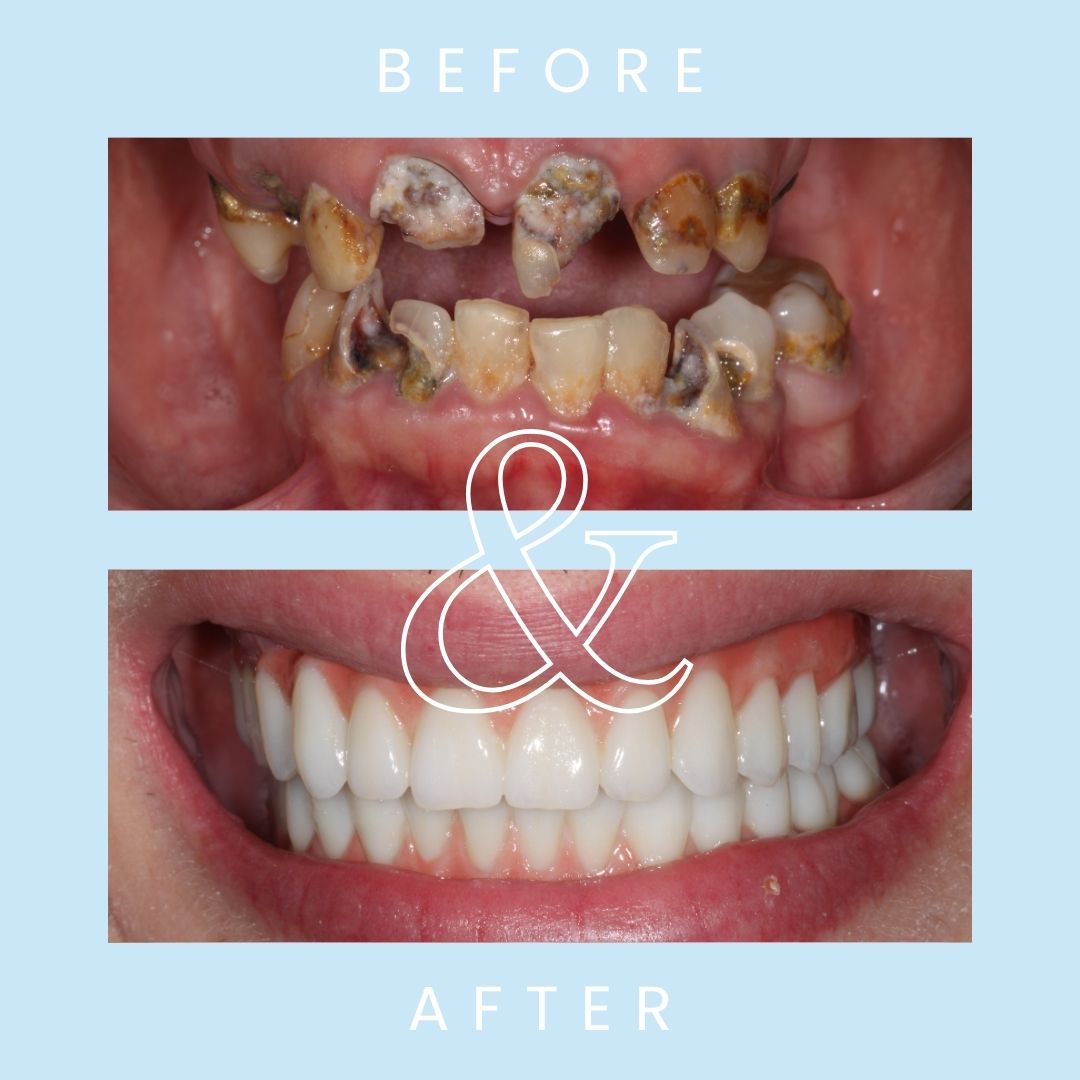 Ugly Teeth Before And After Braces